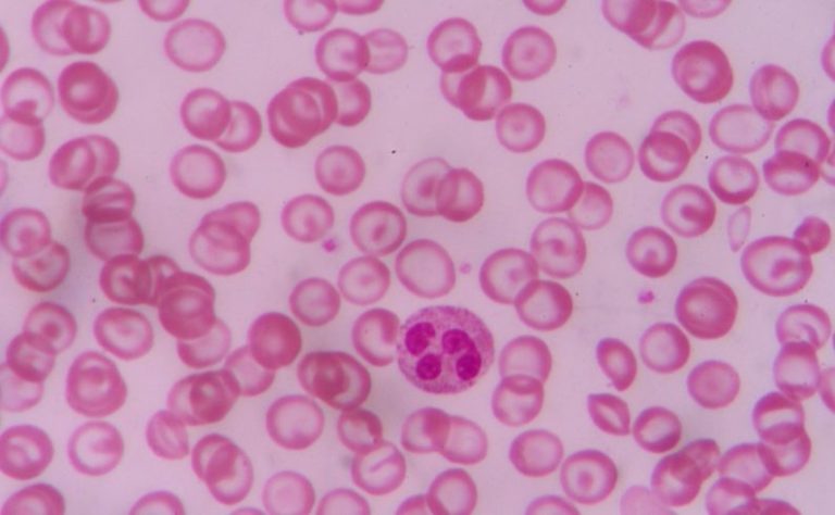 New treatment through stem cell transplant for Sickle cell anemia